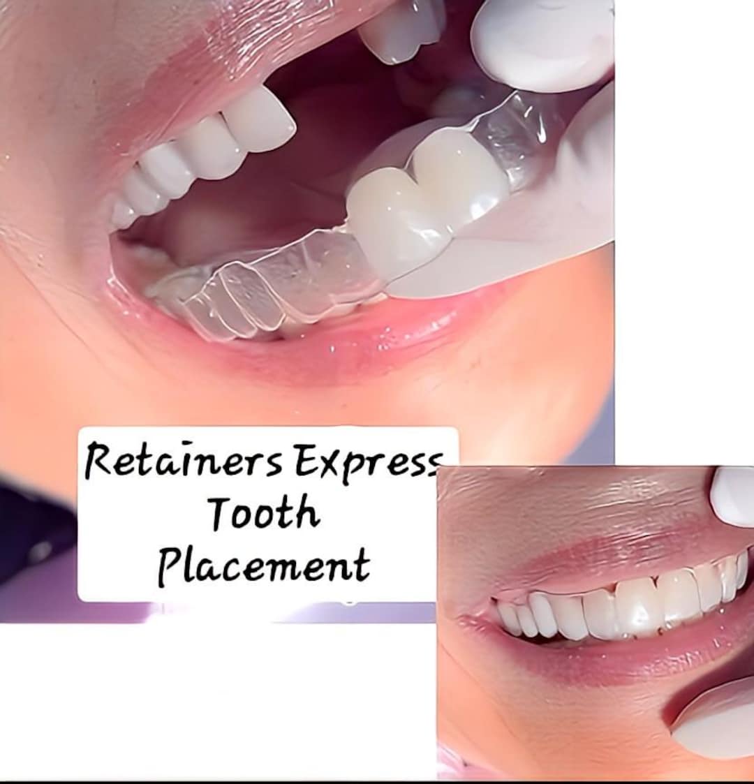 Retainer With Added Teeth, up to 4 in 1 Ret) Do You Have Missing Front ...