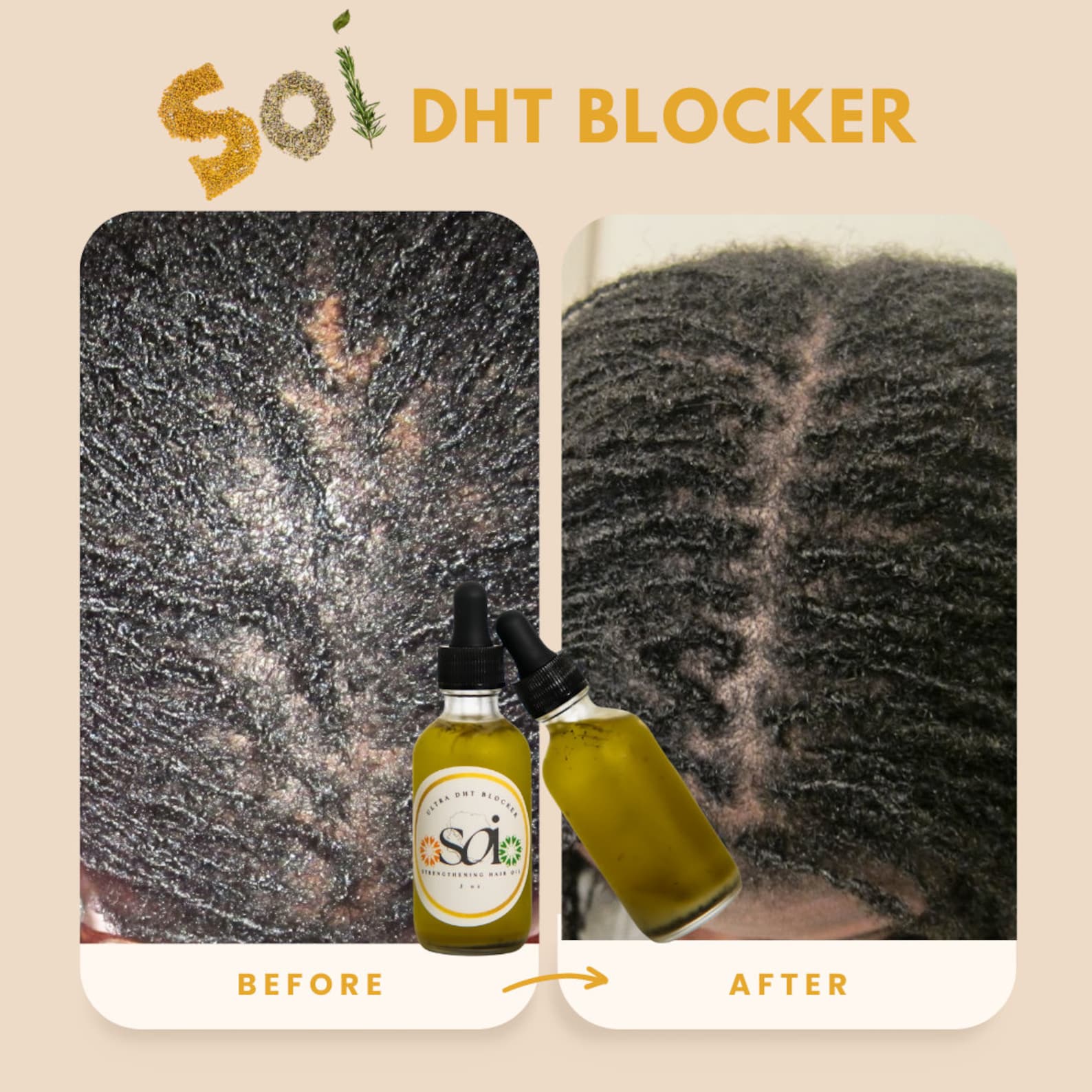 Rosemary Hair Growth Oil: Ayurvedic DHT Blocker, Alopecia Treatment - Etsy