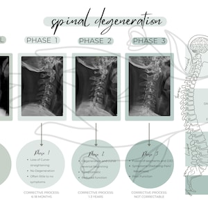 Spinal Degeneration Poster Pdf Download - Etsy
