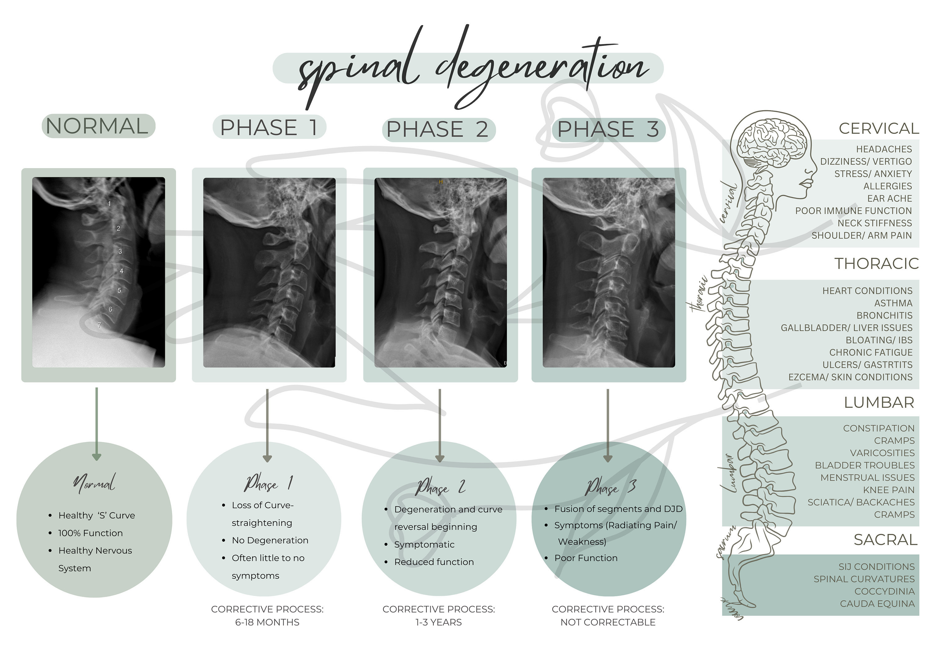 Spinal Degeneration Poster Pdf Download - Etsy