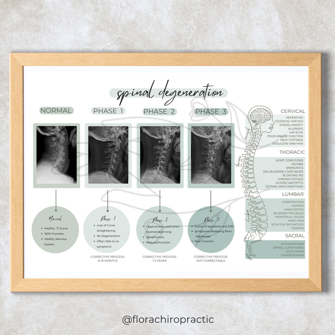 Spinal Degeneration Poster Pdf Download - Etsy