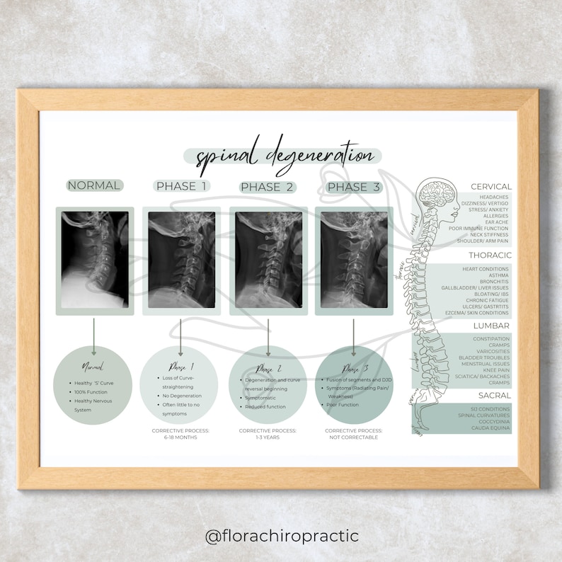 Spinal Degeneration Poster Pdf Download - Etsy