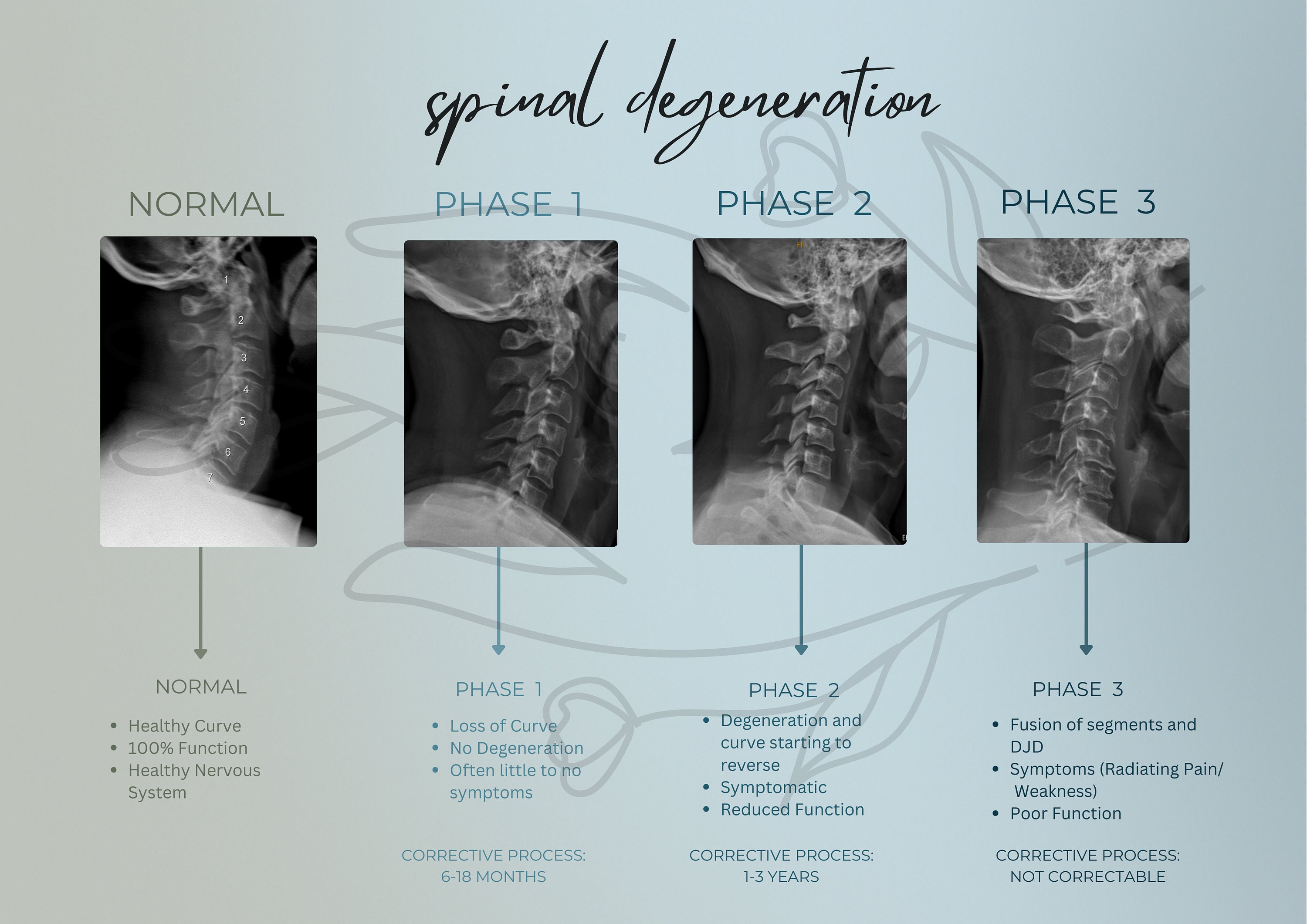 Spinal Degeneration Poster Pdf Download - Etsy