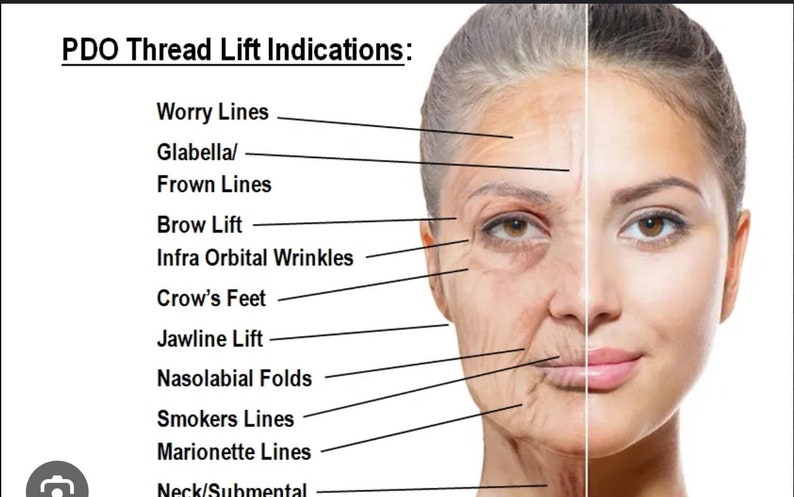 PDO Thread Lift Consent Form EDITABLE - Etsy