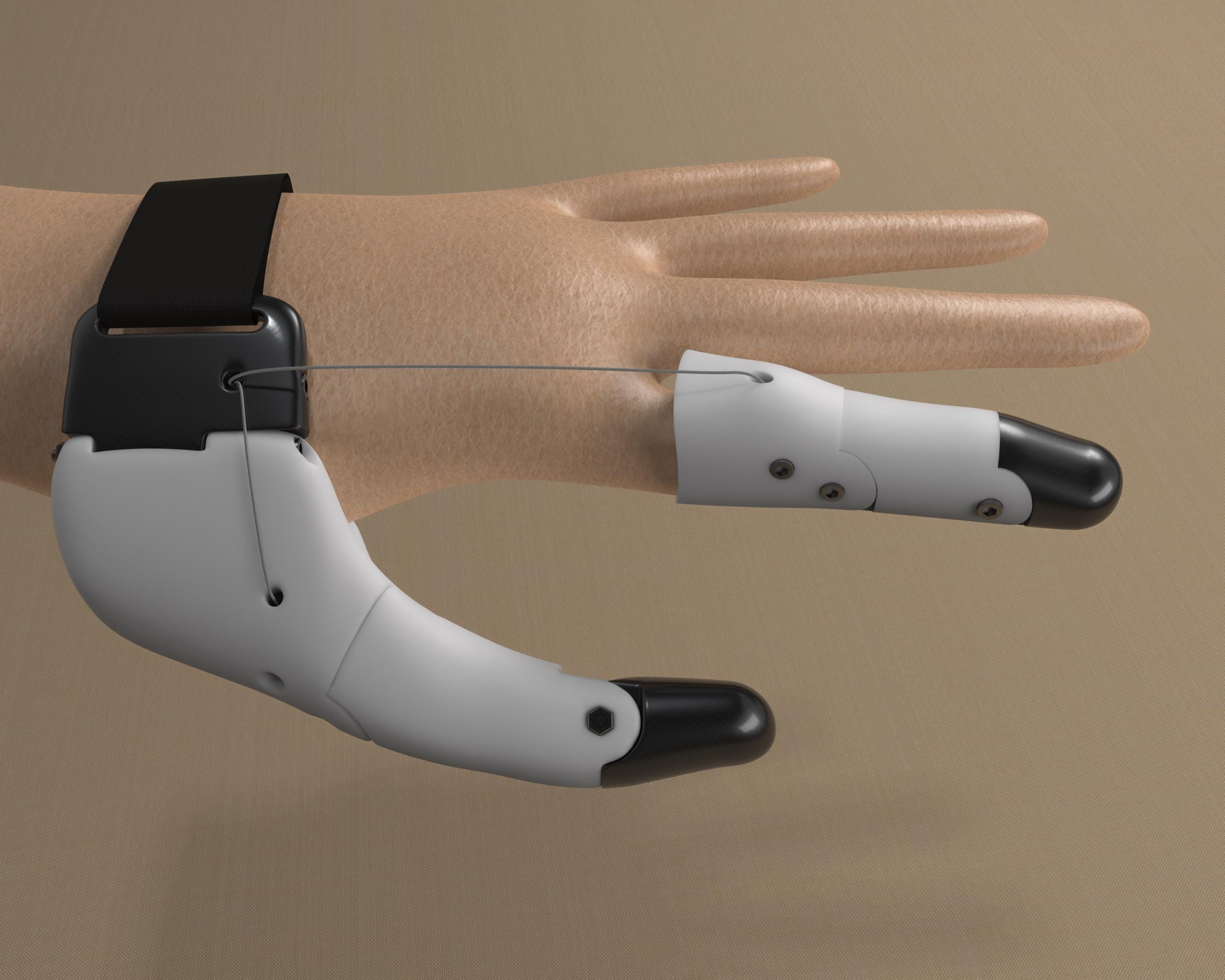 3D Print Full Hand Prosthetic STL File: DIY Finger Replacements ...