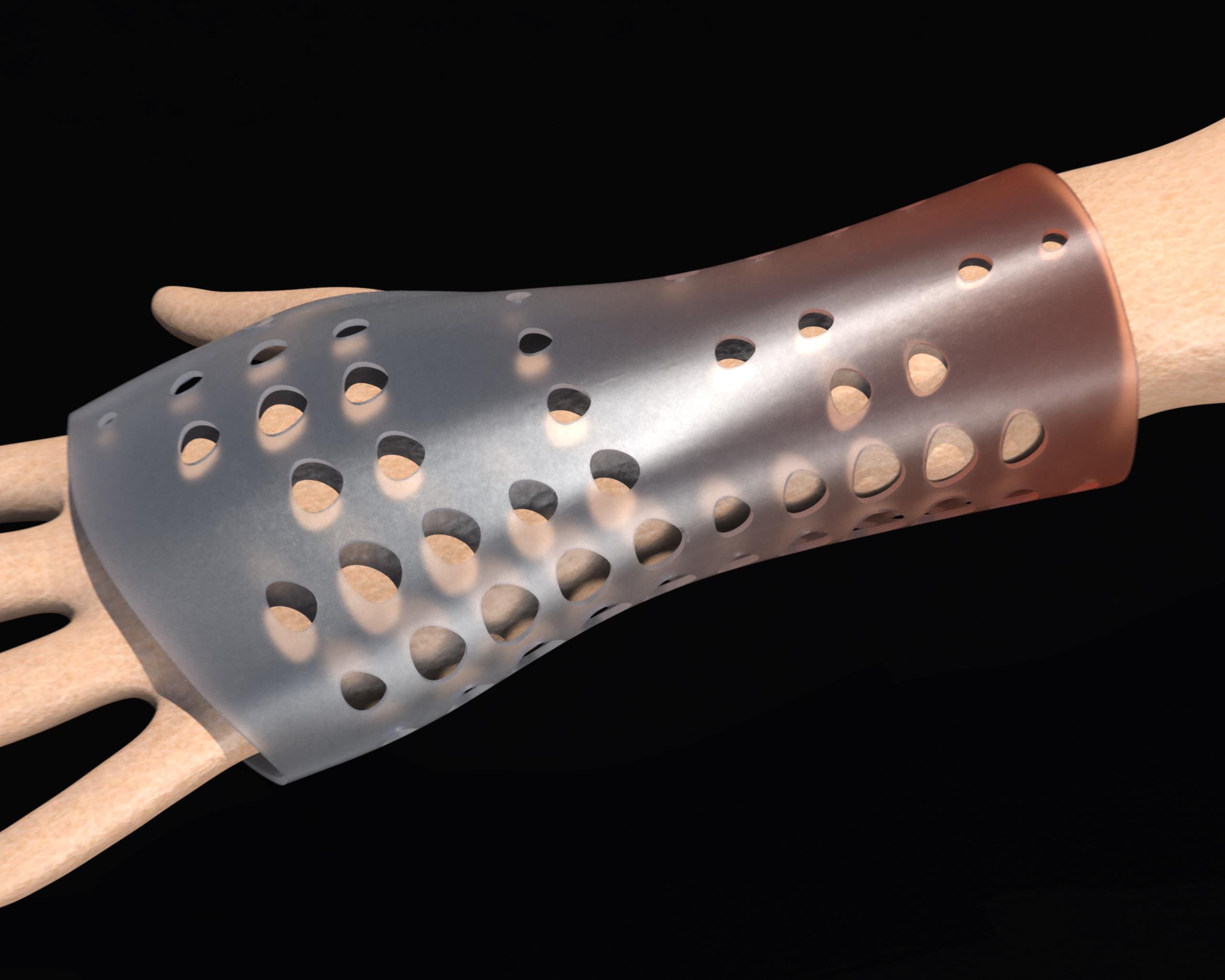 3D Printed Wrist Splint STL File: Adjustable Carpal Tunnel Brace ...