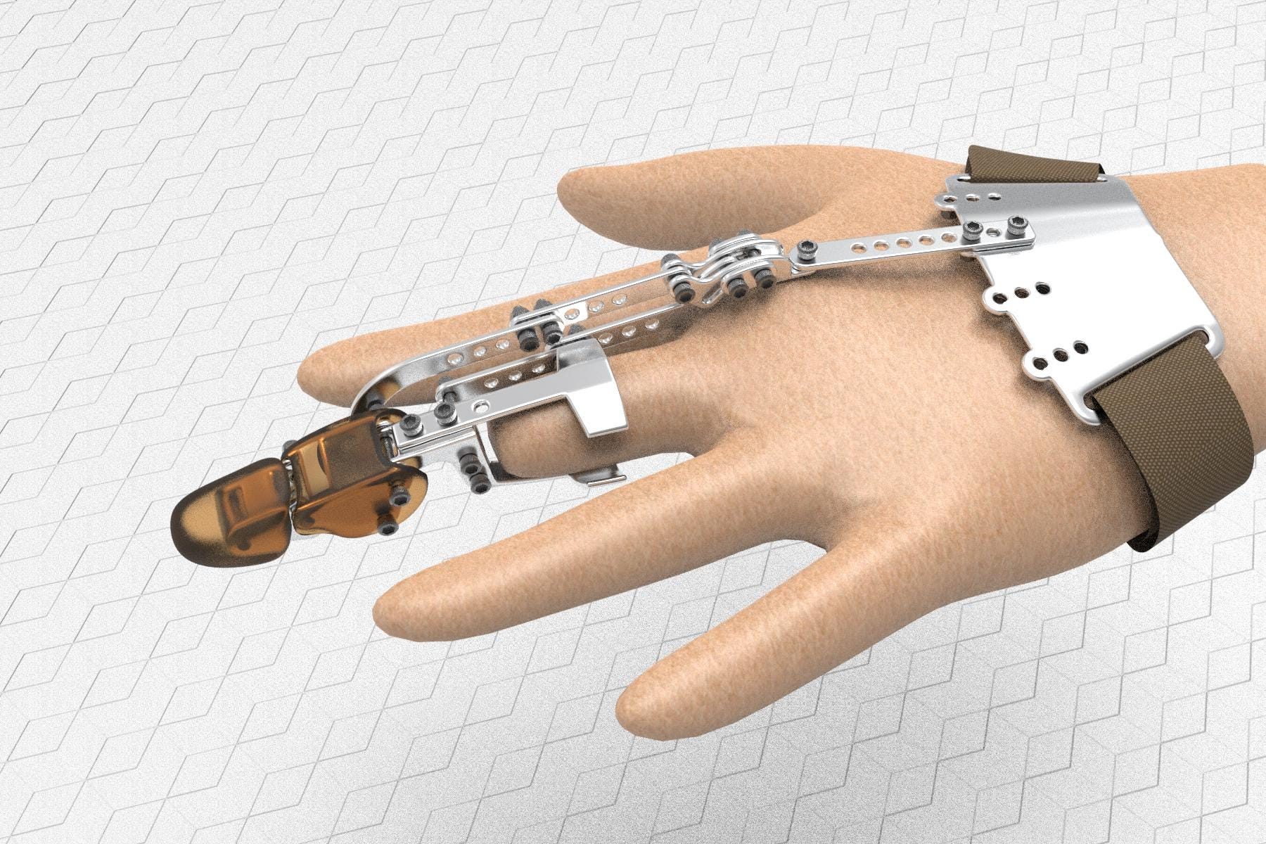 Adjustable Laser Cut Metal Hand Prosthesis With 3d-printed Finger ...
