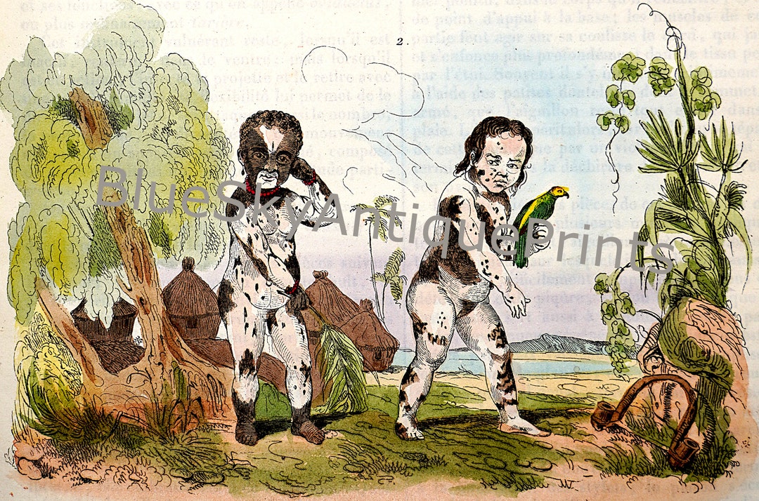 Antique 18th-century Illustration of Children Affected by the Genetic ...