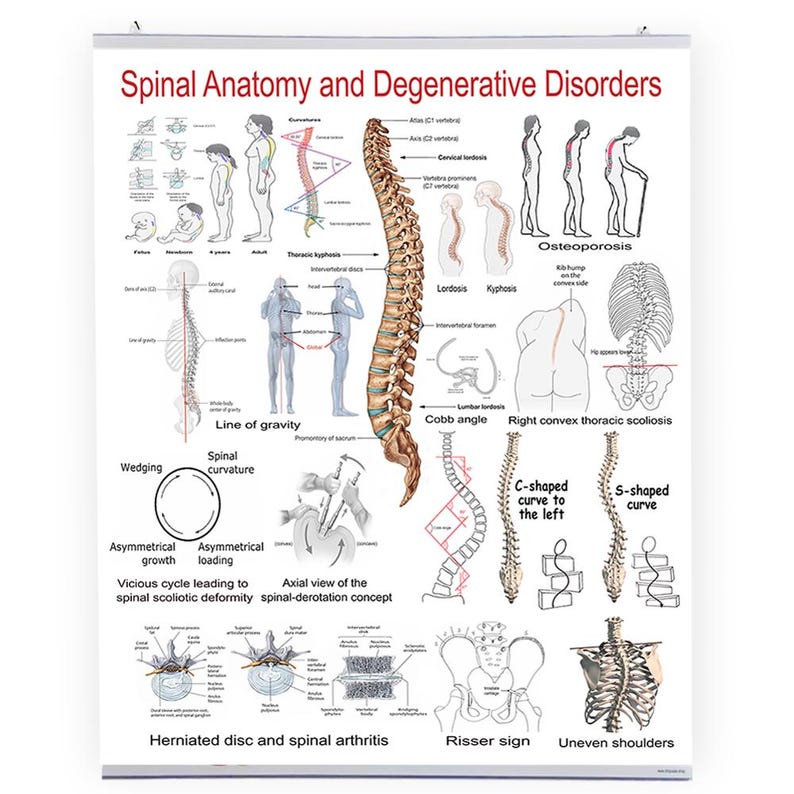 Spinal Anatomy & Disorders Poster: Scoliosis, Disc Herniation—medical ...