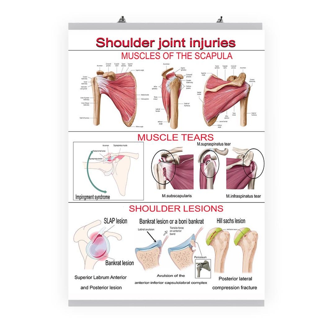 Shoulder Anatomy and Injuries Poster – Scapula Muscles, Tears and ...