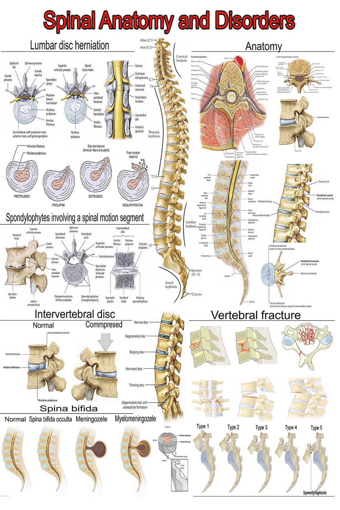 Spine Anatomy and Disorders Poster: Visual Guide (PDF) - Etsy