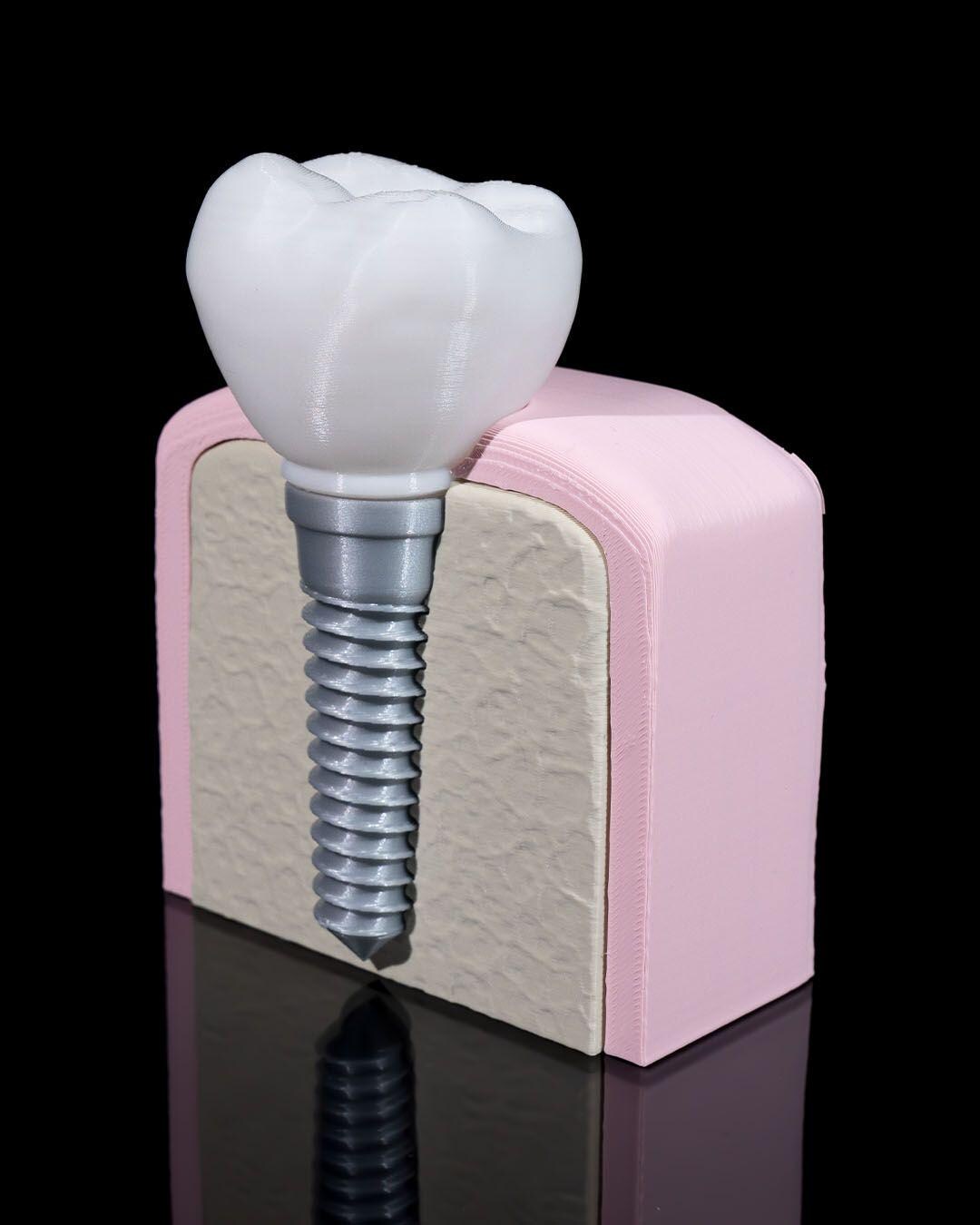 Dental Implant Model 3D Print – High Quality Educational Dental Anatomy ...