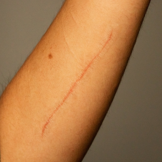 Realistic scar tattoo - Bronctattooaus.com