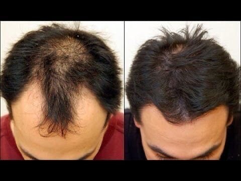 Natural Hair Growth | GROWTHLOCK PRO+ - Etsy