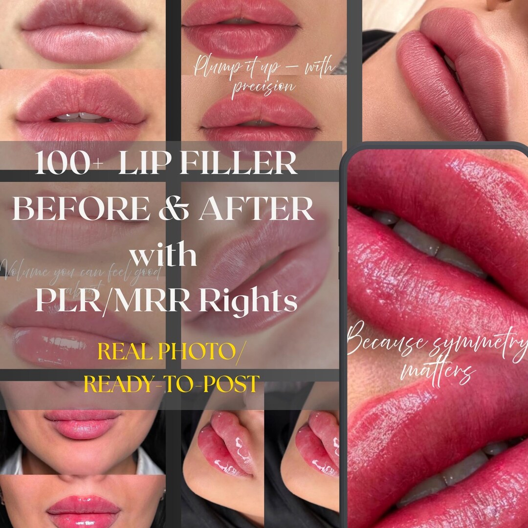 PLR 100 Lip Filler Instagram Templates, Lip Injection Before and After ...