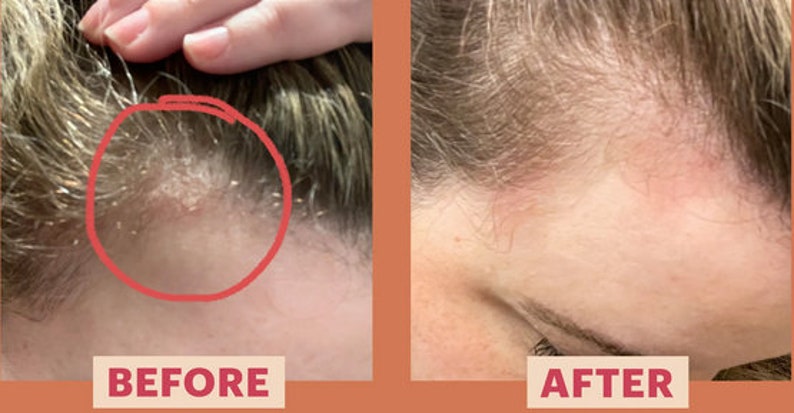 Seborrheic Dermatitis Relief Spray Itchy & Flaky Scalp Treatment Anti ...