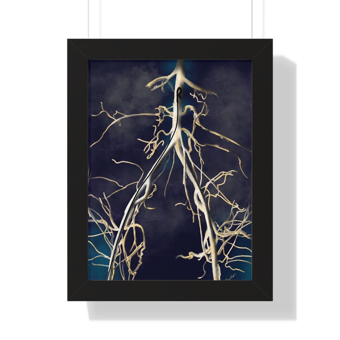 Angiography Aorta Framed Art Poster for Interventional Radiology and ...