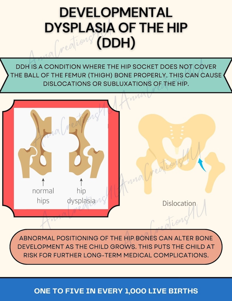 Developmental Dysplasia of the Hip DDH, Cerebral Palsy, Down Syndrome, Low Tone, Dislocation ...