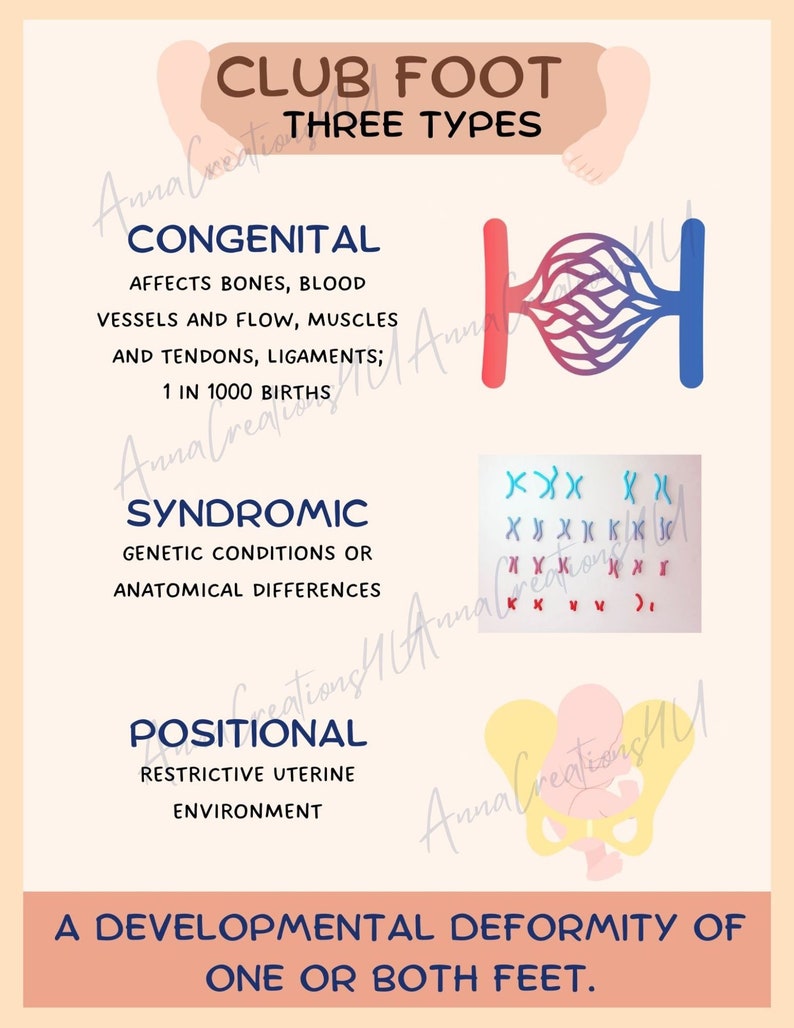 Club Foot Congenital Condition, Postpartum, Prenatal, Newborn, Infant ...