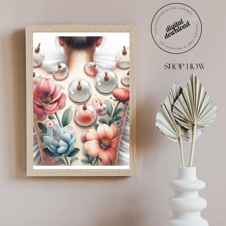 Cupping Therapy Artwork, Cupping Therapy, Vacuum Cupping Print ...