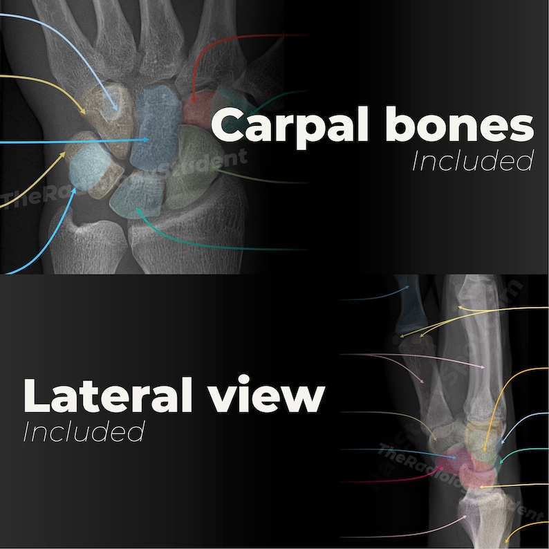 Hand and Wrist X-ray - Radiology Anatomy Quiz - Study Materials for ...