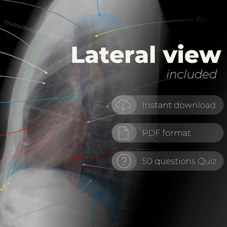 Chest X-ray Anatomy | Labelled Radiography Notes - Etsy Australia