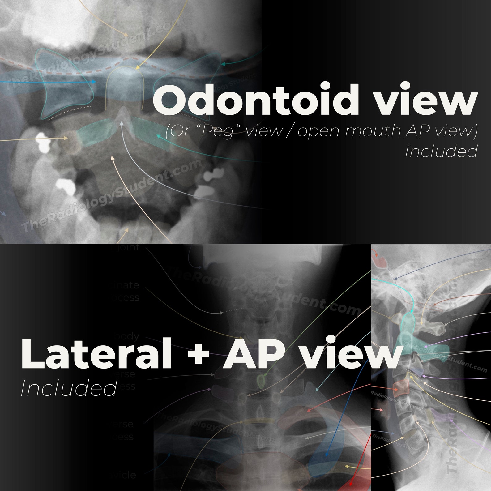 Cervical Spine X-ray Anatomy Quiz | Diagnostic Radiology Study Guide ...