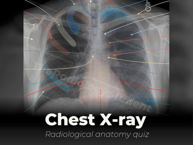 Chest X-ray Anatomy | Labelled Radiography Notes - Etsy