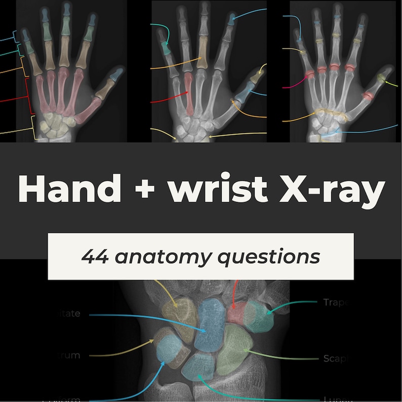 Hand and Wrist X-ray - Radiology Anatomy Quiz - Study Materials for ...