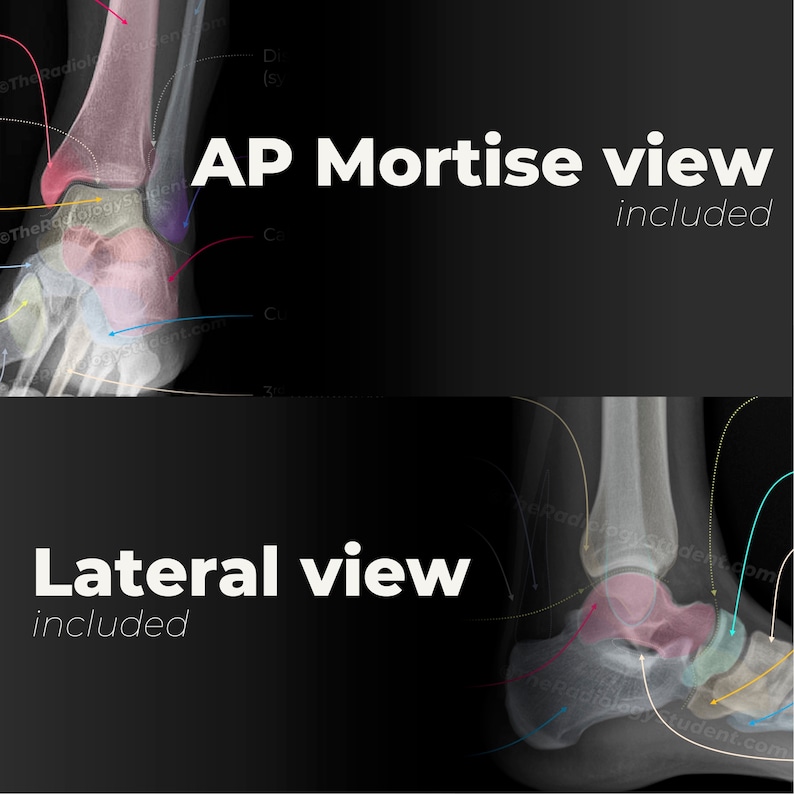 Ankle Xrays Annotated - Labeled Quiz to Learn Radiology Anatomy - Etsy