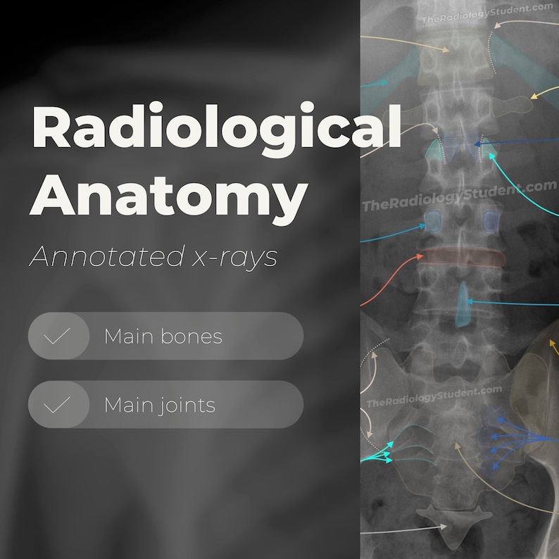 Lumbar Spine Radiology Note | Annotated X-ray Quiz to Learn Radiology ...
