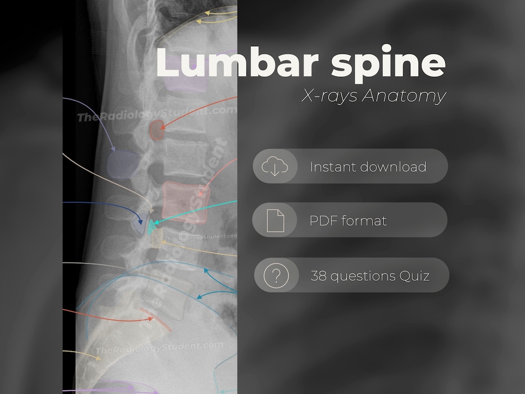 Lumbar Spine Radiology Note | Annotated X-ray Quiz to Learn Radiology ...