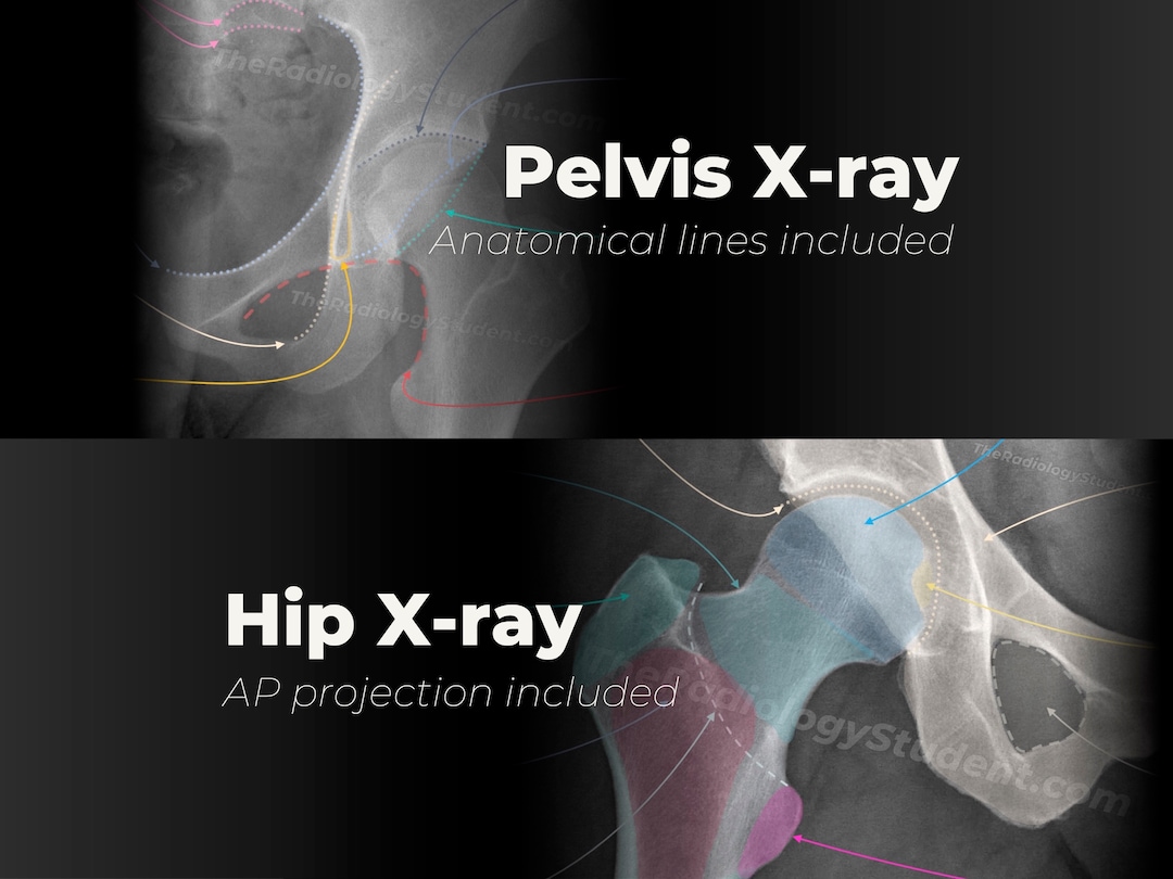 Pelvis & Hip Xray Anatomy Quiz | Study Material for Radiology ...