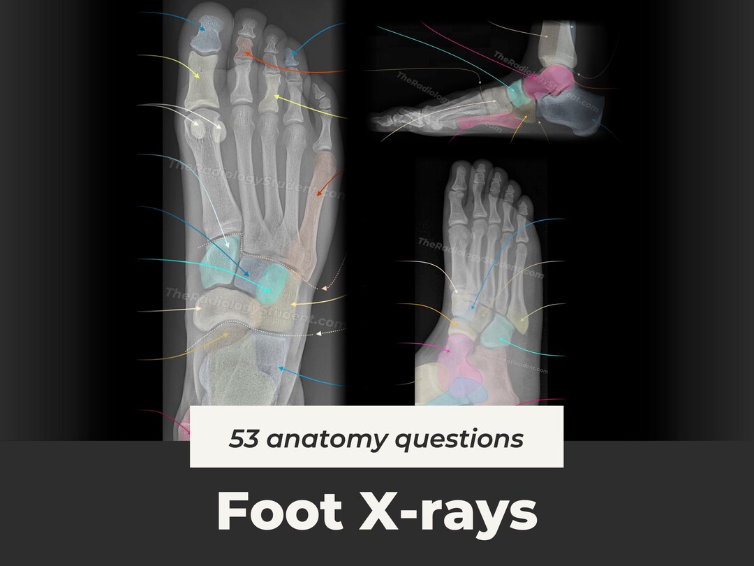 Foot Radiography Anatomy | Radiology Study Aid for Beginner | Annotated ...