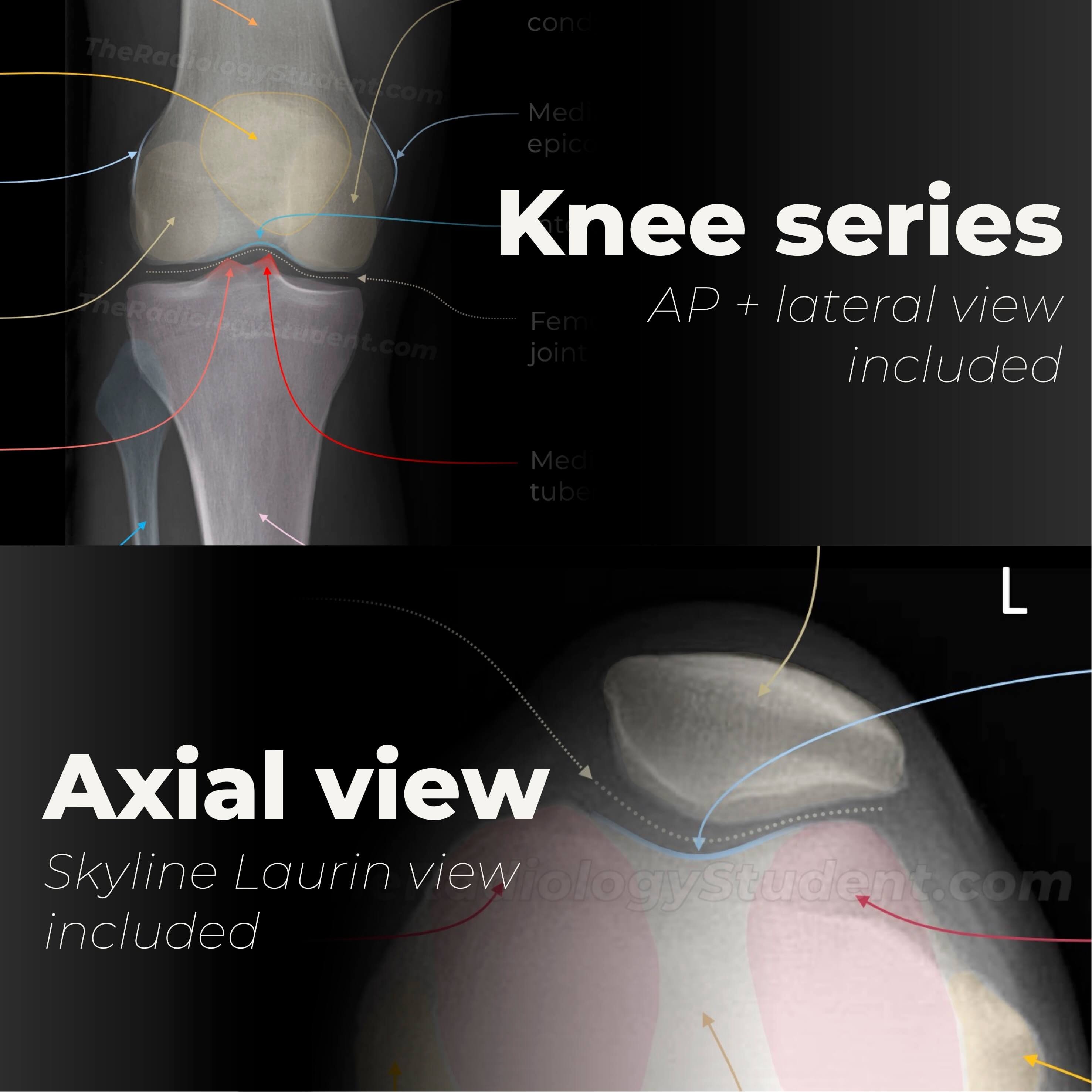 Knee X-rays Labeled Quiz | Study Notes for Rad Tech, Nurse and Medical ...