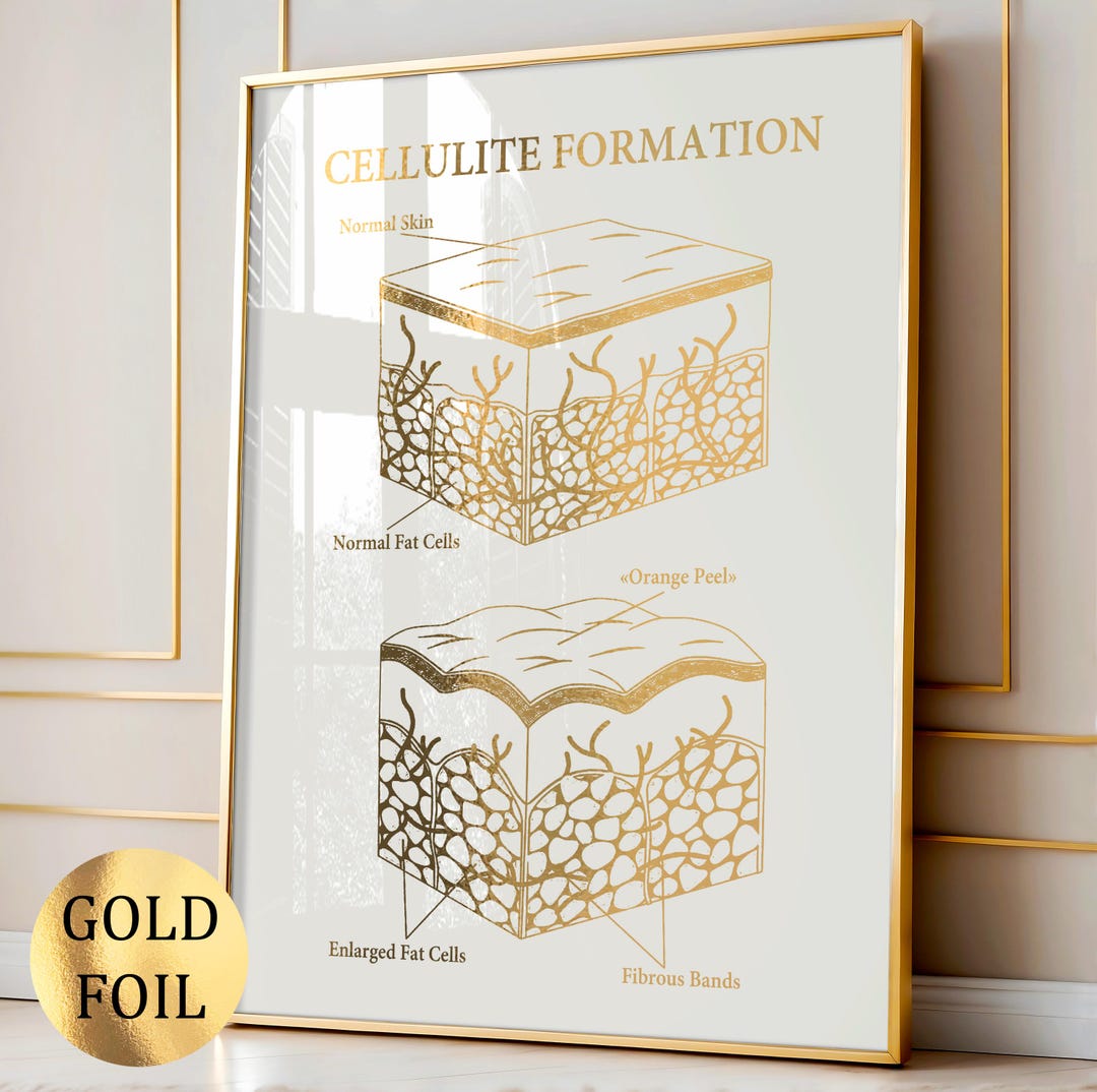 Cellulite Skin Poster Cellulite Formation Diagram Skin Care Art ...