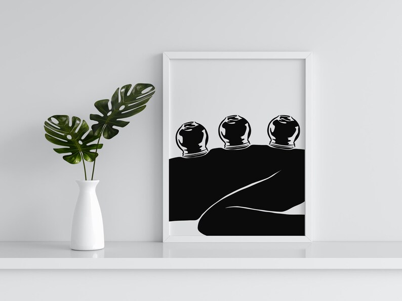 Cupping Massage Therapy Art Print Digital Acupuncture Poster ...
