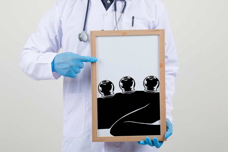 Cupping Massage Therapy Art Print Digital Acupuncture Poster ...