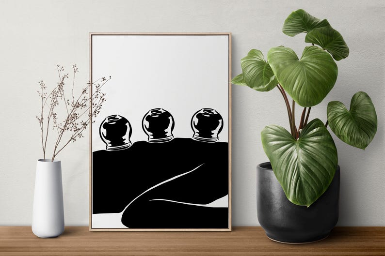 Cupping Massage Therapy Art Print Digital Acupuncture Poster ...