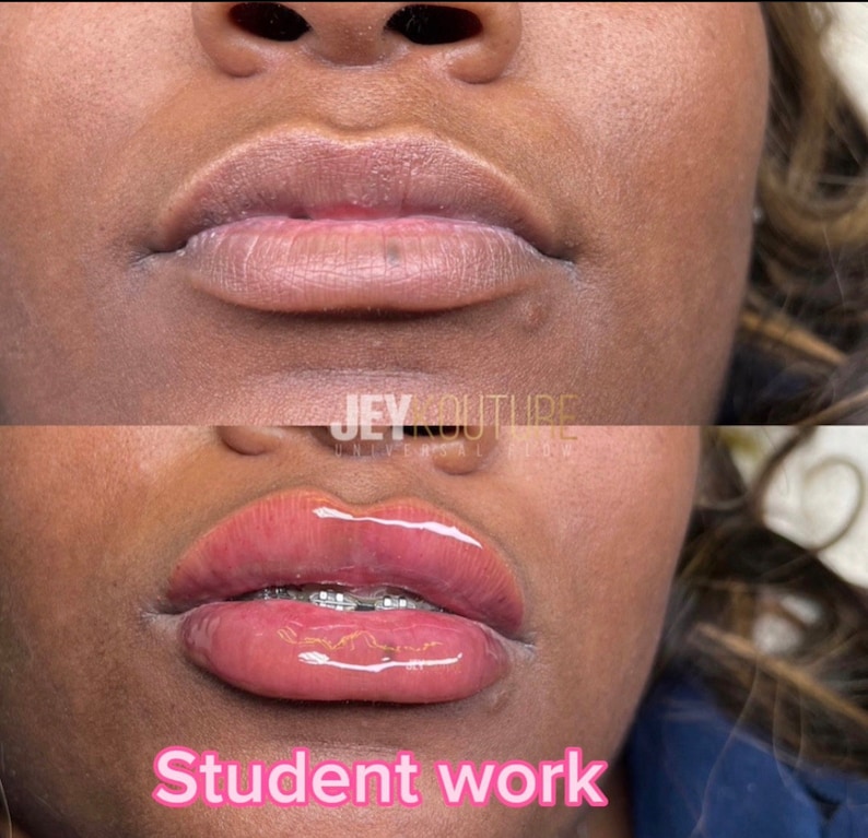 Hyaluron Pen Lip Maps, Lip Mapping Guides, Techniques, Russian Lips ...