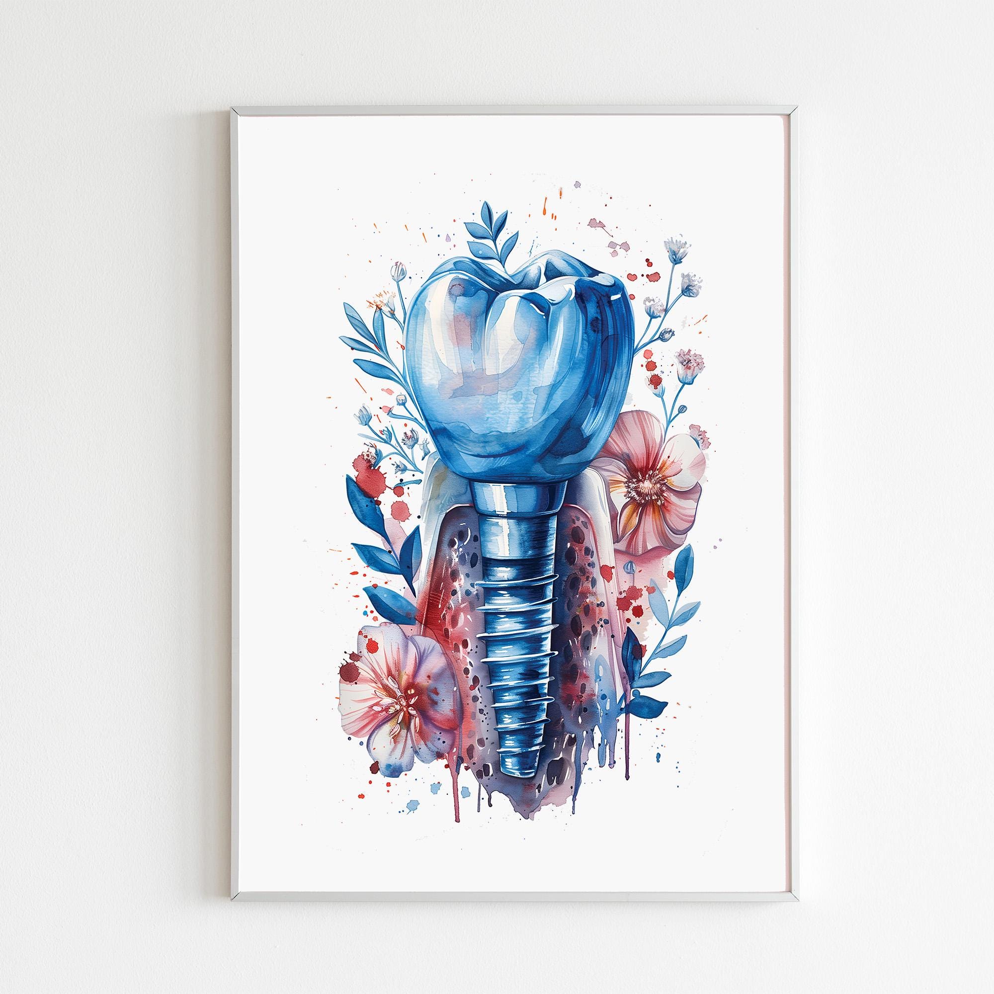 Tooth Implant Art Print Watercolor Dental Wall Art Dentist Office Decor ...