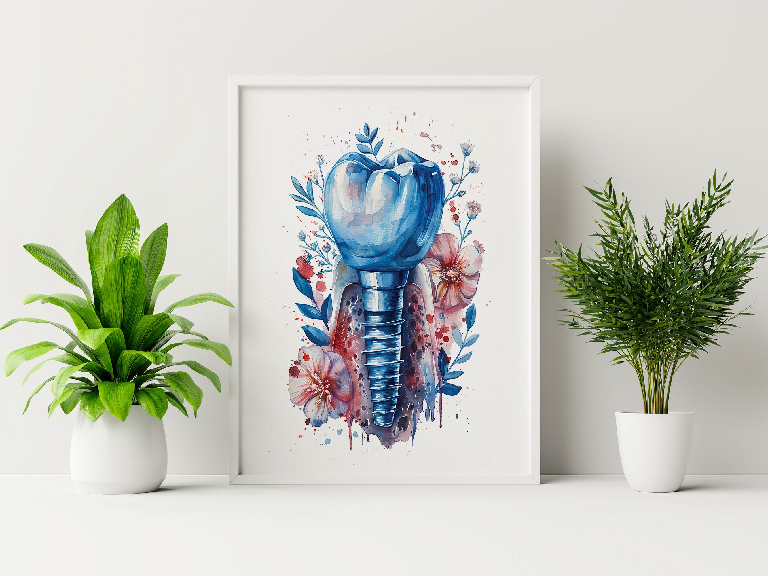 Tooth Implant Art Print Watercolor Dental Wall Art Dentist Office Decor ...
