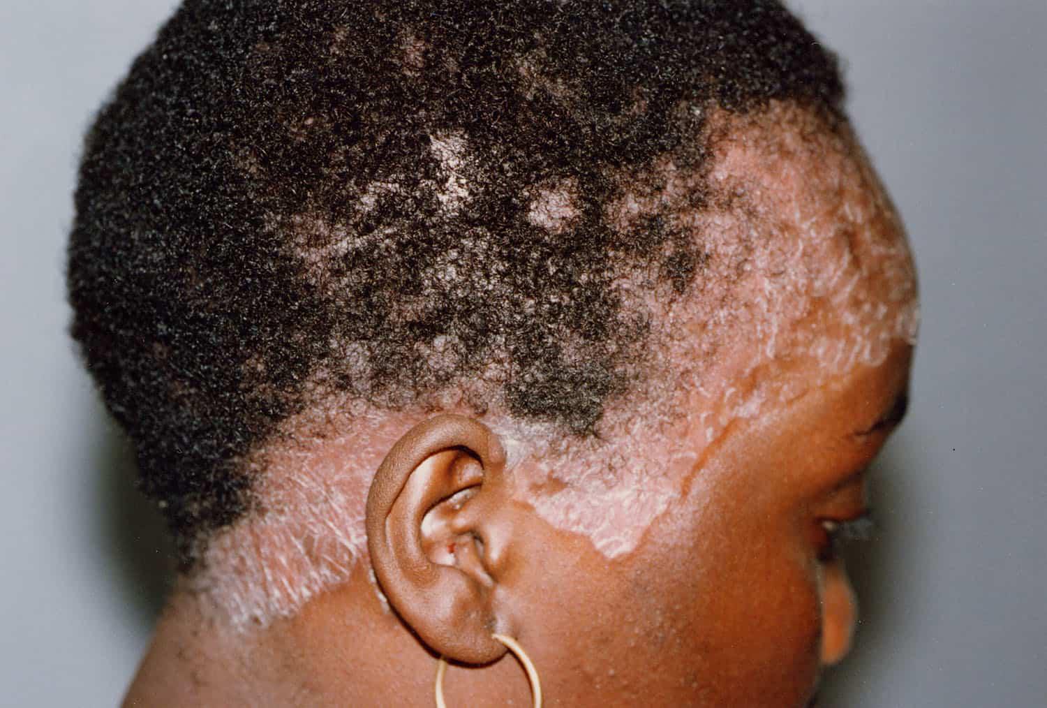 Managing Scalp Psoriasis Etsy