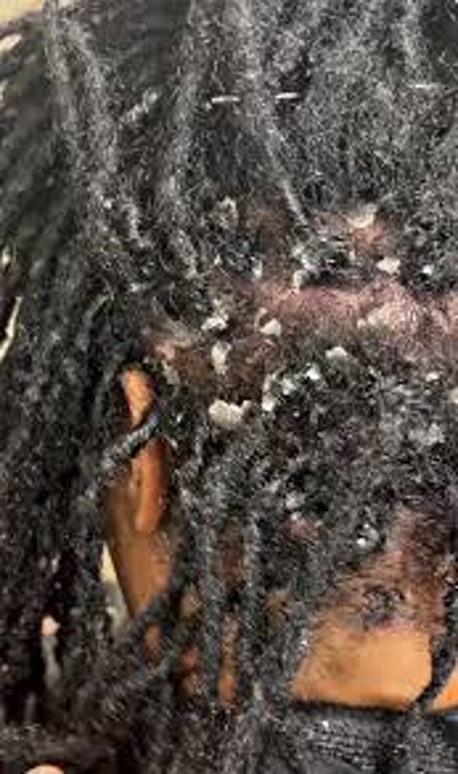 Managing Scalp Psoriasis Etsy