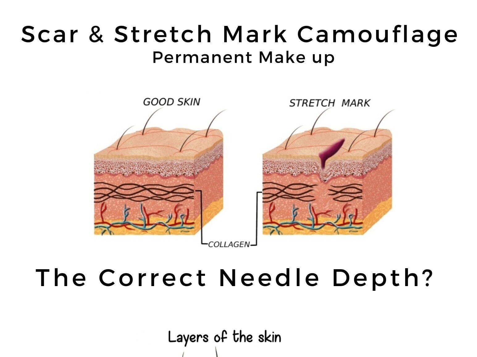 Permanent Make up Needle Depth for Scar & Stretch Mark Camouflage ...