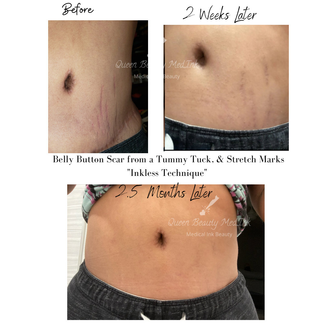 Inkless Serum Recipe for Stretch Mark Rejuvenation - Etsy