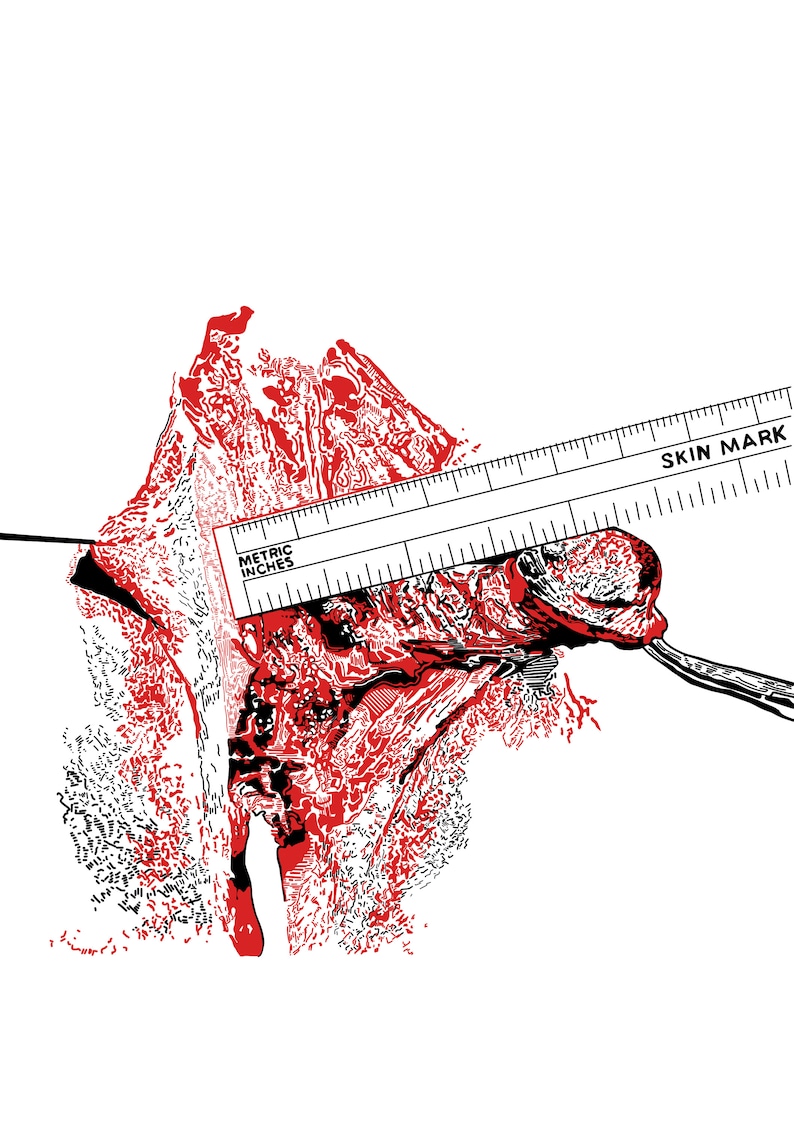 FTM /non-binary Trans Surgery Print: Metoidioplasty 2 single, Black ...