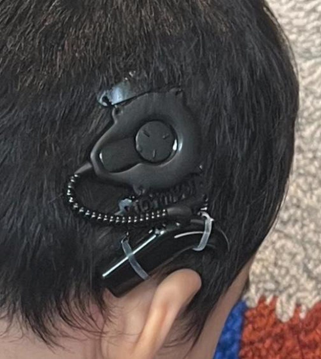 A Resin Case Pin for Securing a Cochlear Implant Without a Band ...