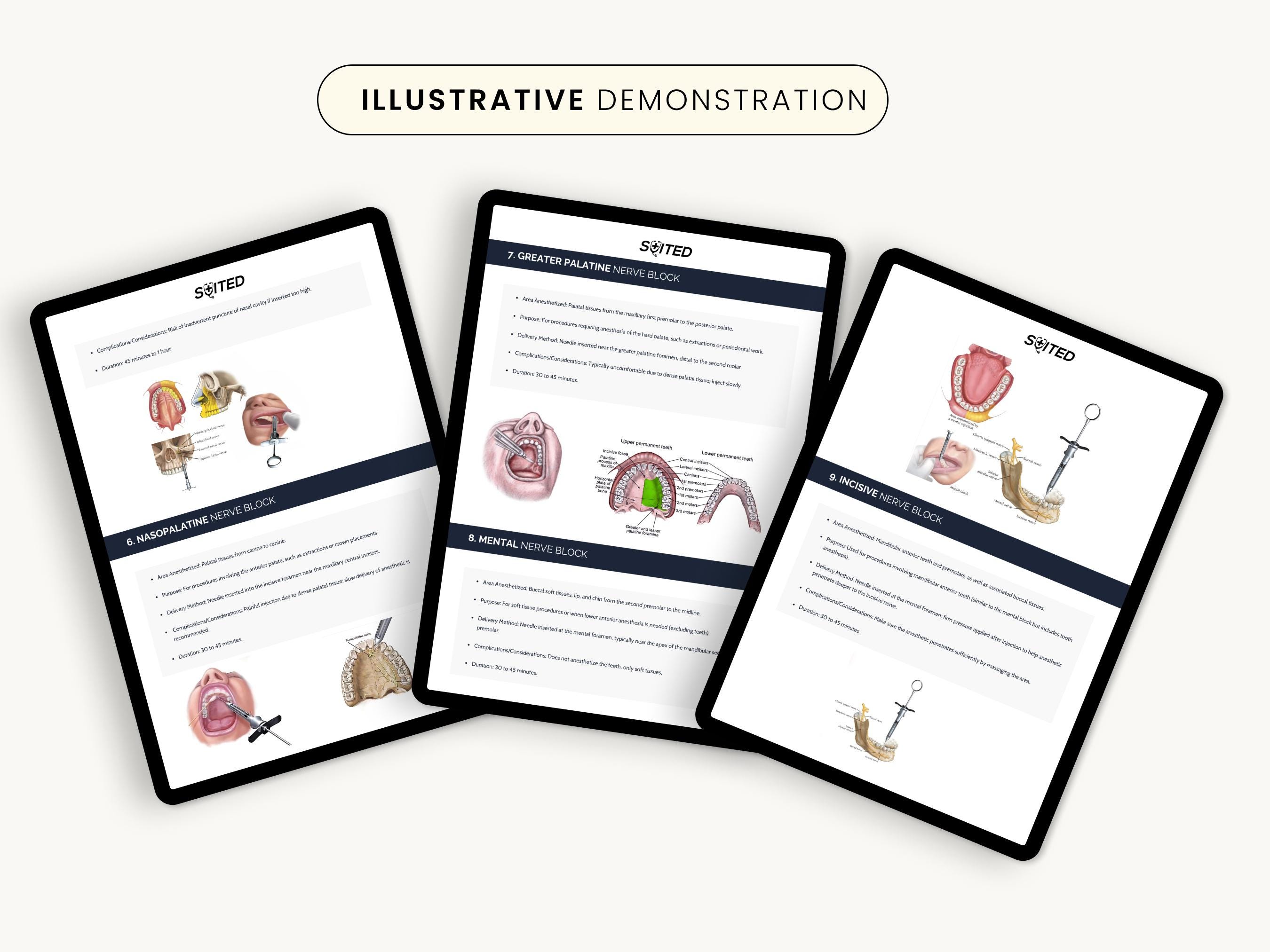 Anesthesia Made Easy: Quick Reference for Dental Hygienists -digital ...