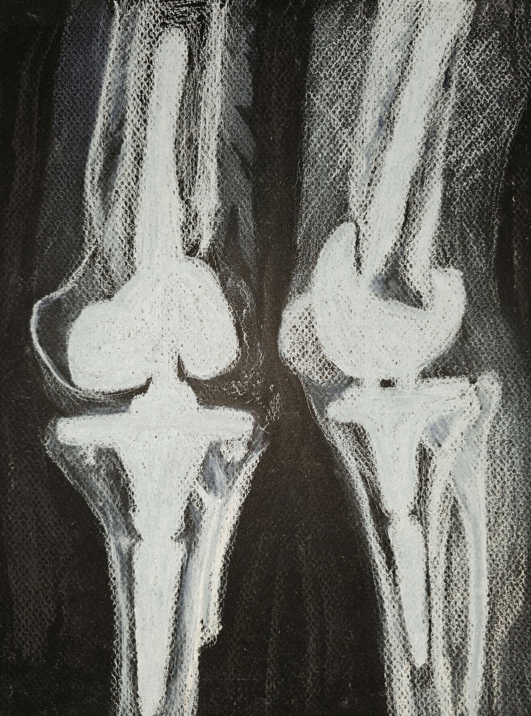 Anatomy Arthroplasty X-ray Art Print 11 X 14 Inches, Medical Art ...